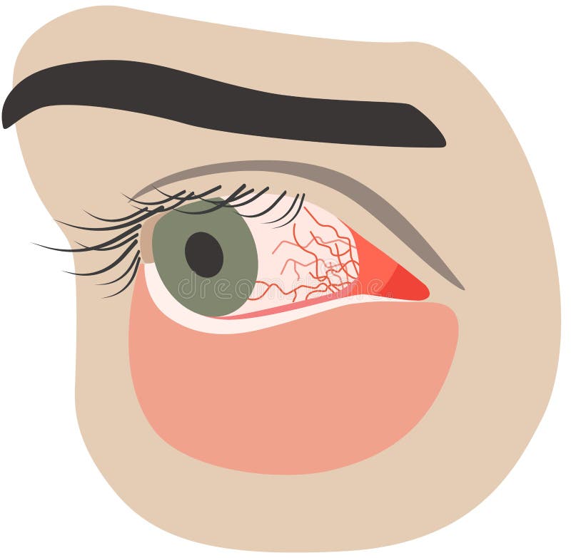 Chronic Conjunctivitis Eye with a Red Iris Stock Vector - Illustration ...