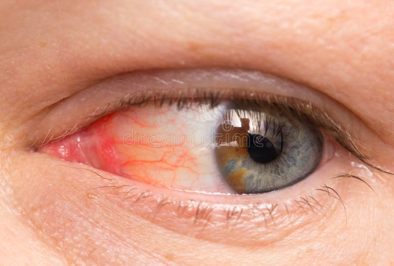 Chronic conjunctivitis eye stock photo. Image of healthy - 31267484