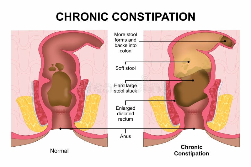 Chronic Constipation Illustration Stock Photo - Illustration of constipation, hand: 391785786