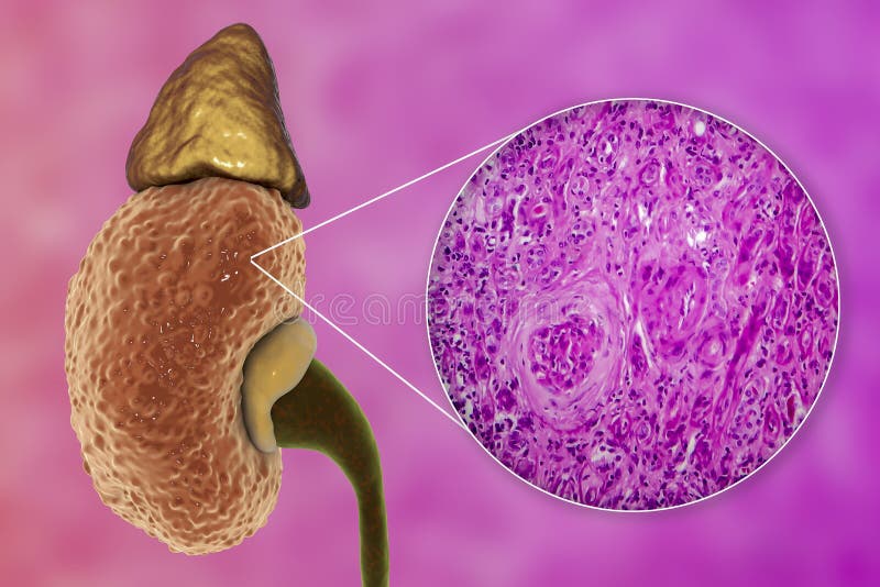 Chronic Glomerulonephritis, Gross Pathology Stock Illustration ...