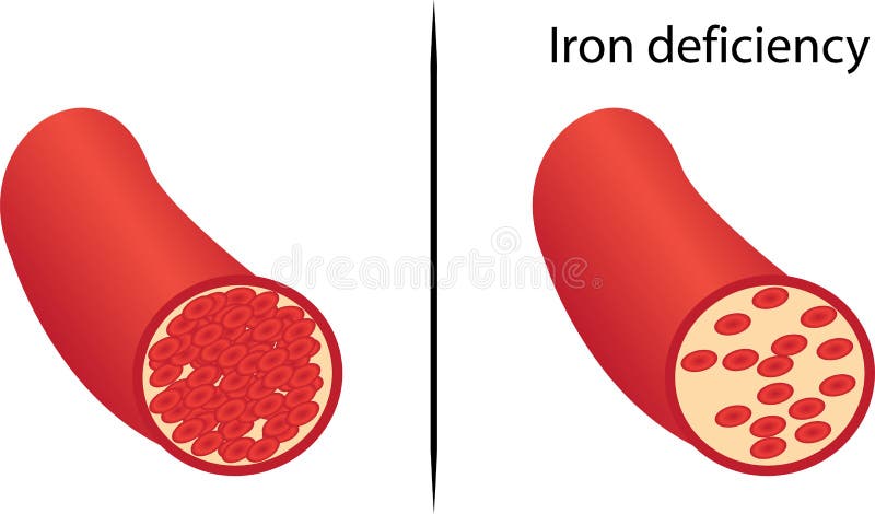Iron Deficiency Stock Illustrations – 471 Iron Deficiency Stock ...