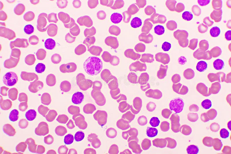 Chronic Lymphocytic Leukemia or CLL Stock Image - Image of basophil ...