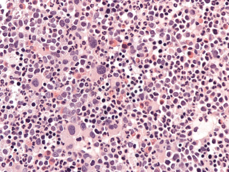 Chronic Myeloid Leukemia, Bone Marrow. Stock Image - Image of ...