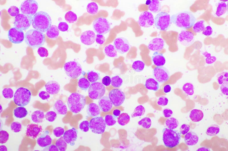Chronic Myeloid Leukemia Cells Stock Photo - Image of science, blood ...