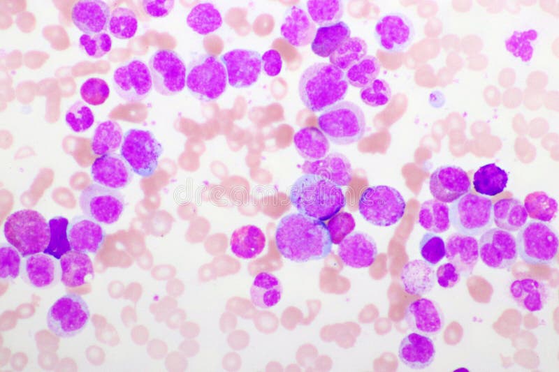 225 Chronic Myeloid Leukemia Stock Photos - Free & Royalty-Free Stock ...