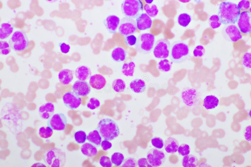 Chronic Myeloid Leukemia Cells or CML Stock Photo - Image of abnormal ...