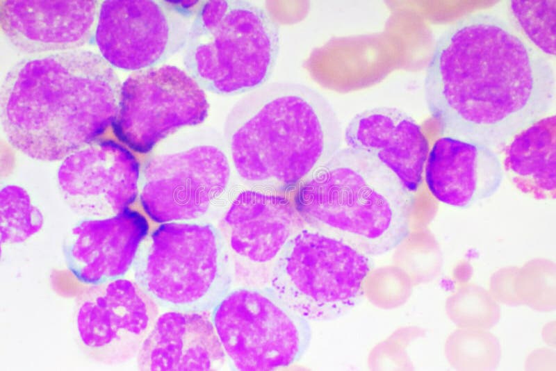 Chronic Myeloid Leukemia Cells Stock Image - Image of white, smear ...