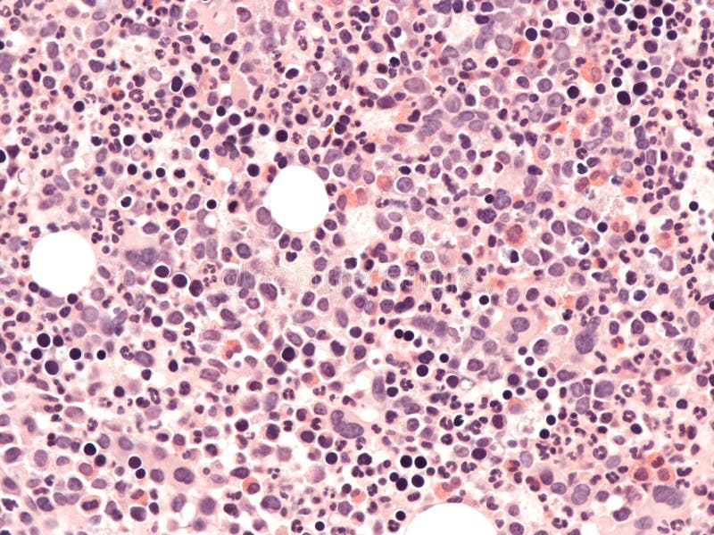 Chronic Myeloid Leukemia, Bone Marrow. Stock Image - Image of ...