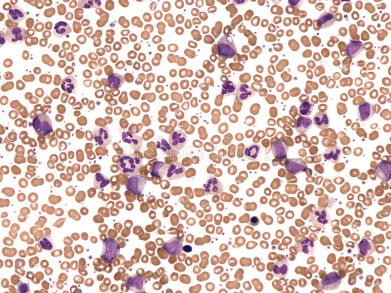 Chronic Myeloid Leukemia, Peripheral Blood Editorial Stock Image ...