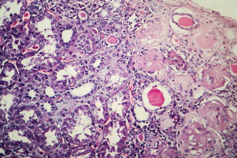 Chronic Nephritis, Light Micrograph Stock Photo - Image of chronic ...