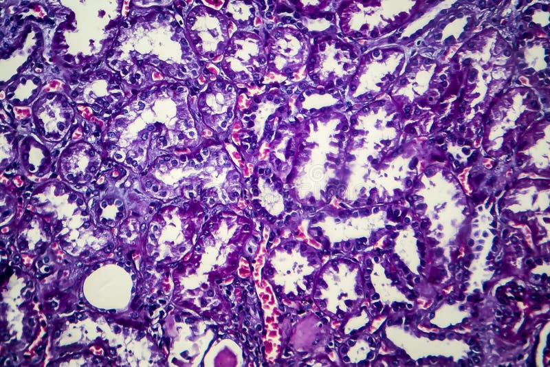 Chronic Nephritis, Light Micrograph Stock Image - Image of renal ...