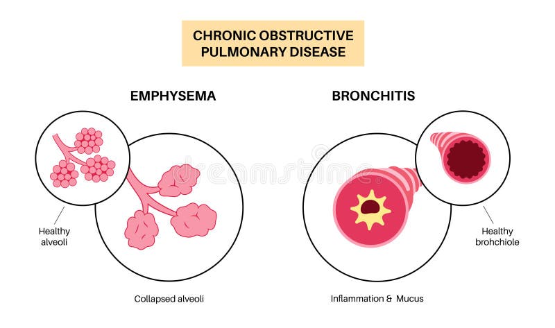 Chronic Obstructive Pulmonary Disease Stock Vector - Illustration of ...