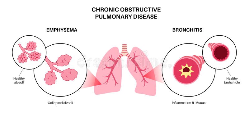 Chronic Obstructive Pulmonary Disease Stock Vector - Illustration of ...