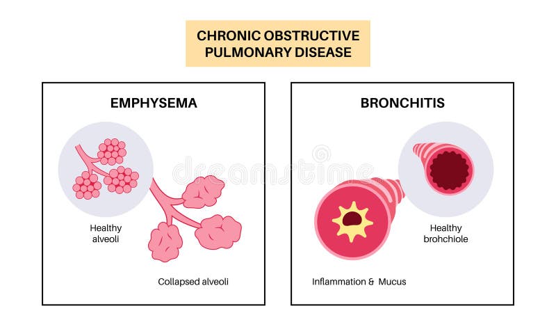 Chronic Obstructive Pulmonary Disease Stock Vector - Illustration of ...