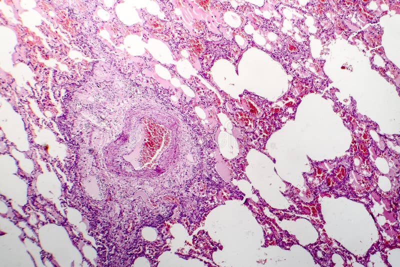 Chronic Pulmonary Congestion and Edema Stock Image - Image of ...