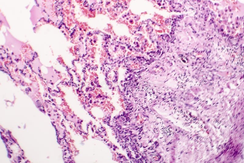 Chronic Pulmonary Congestion and Edema Stock Photo - Image of ...