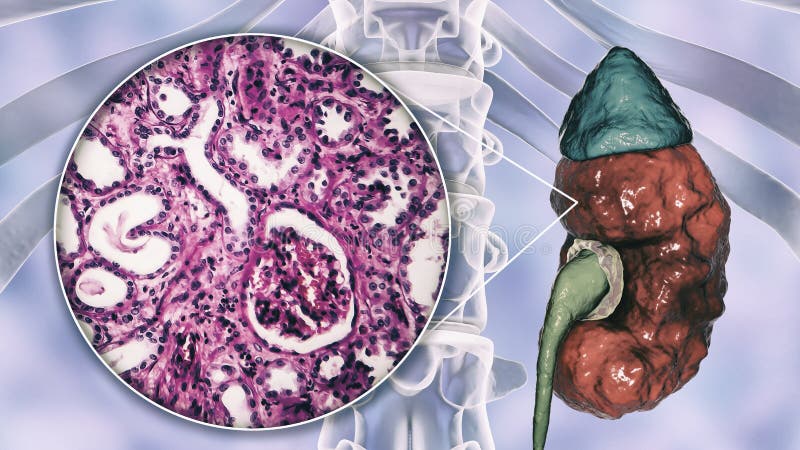 Chronic Pyelonephritis, Illustration and Light Micrograph Stock ...