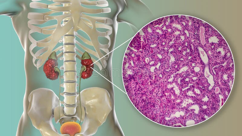 Chronic Pyelonephritis, Illustration and Light Micrograph Stock ...