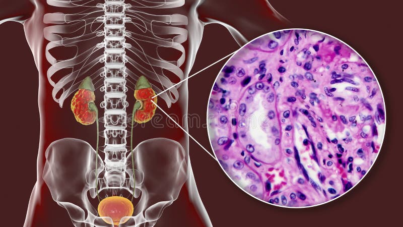 Chronic Pyelonephritis, Illustration and Light Micrograph Stock ...