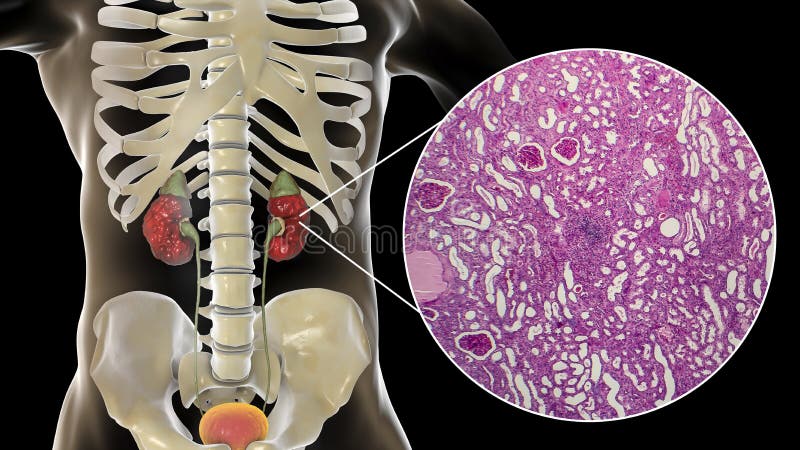 Chronic Pyelonephritis, Illustration And Light Micrograph Stock ...