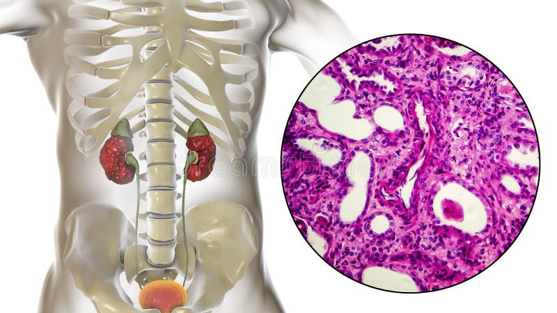 Chronic Pyelonephritis, Illustration and Light Micrograph Stock ...