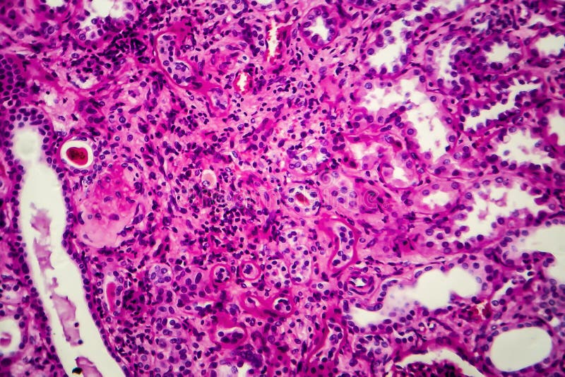 Chronic Pyelonephritis, Light Micrograph Stock Photo - Image of ...