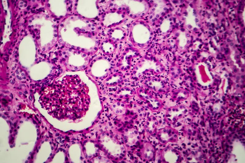 Chronic Pyelonephritis, Light Micrograph Stock Photo - Image of kidney ...