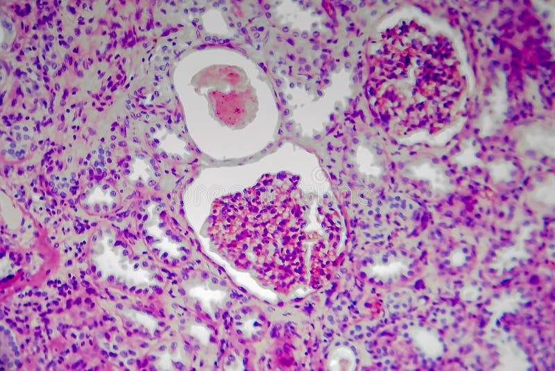 Chronic Pyelonephritis, Light Micrograph Stock Photo - Image of eosin ...