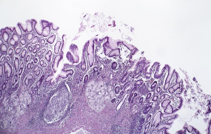 Chronic Superficial Gastritis, Light Micrograph Stock Illustration ...