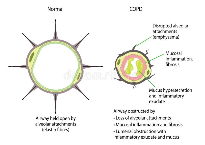 Chronische Hemmende Lungenkrankheit Vektor Abbildung - Illustration von ...