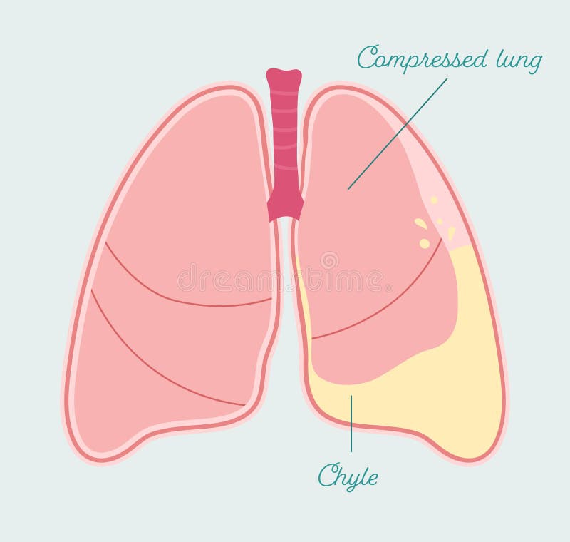 Chylothorax in Human Lung. Accumulation of Lymph in Pleural Space ...