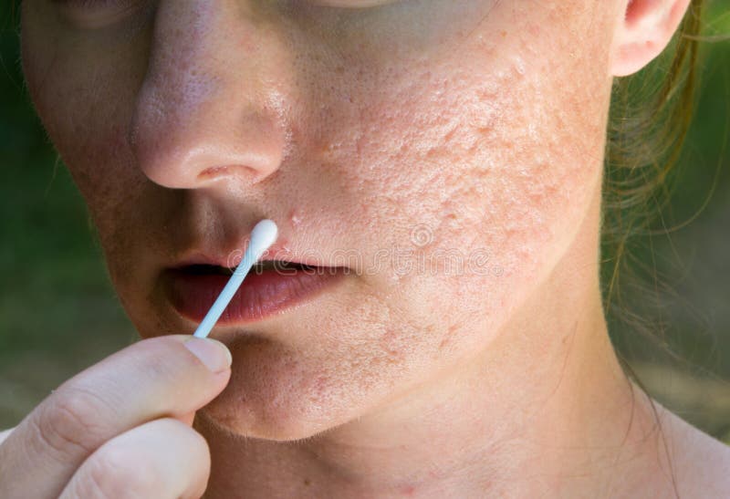 Cicatrices De Bouton Et D'acné Image stock - Image du santé, infection ...