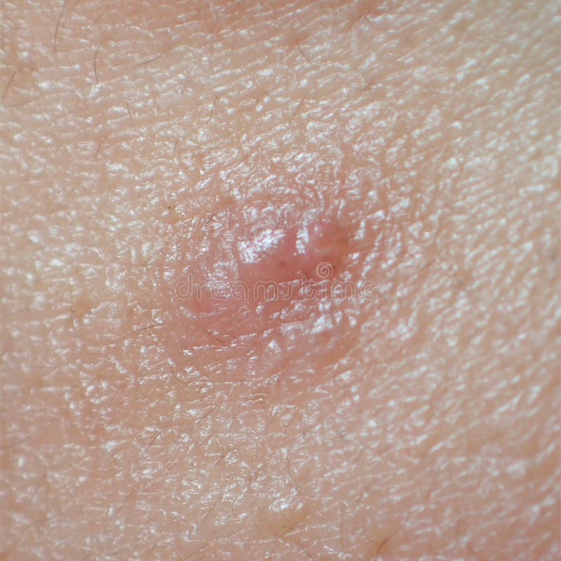 Acne, Cicatrici E Cheloidi Nel Petto Dell'uomo. Fotografia Stock ...