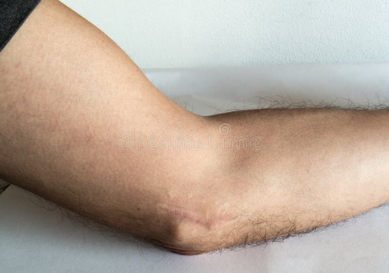 Cicatriz en el codo imagen de archivo. Imagen de pierna - 165480873