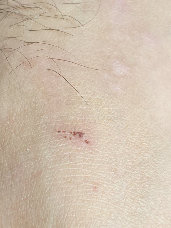 Cicatriz En El Cuerpo Humano Foto de archivo - Imagen de paciente, superficie: 260049758