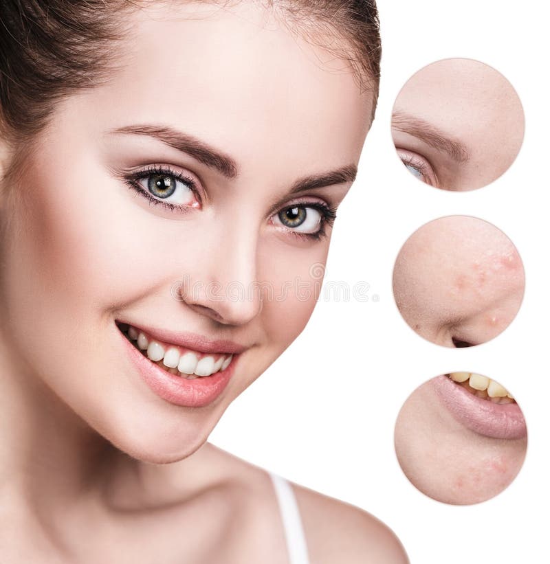 Circles Shows Problem Skin of Young Woman. Stock Photo - Image of ...