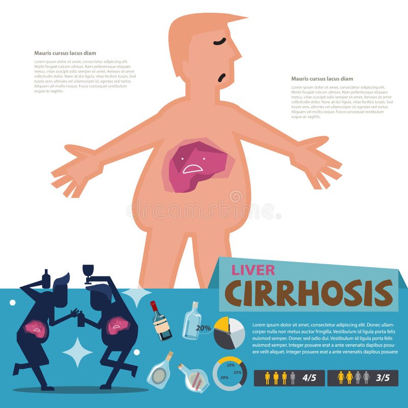 Cirrosi Epatica Infographic - Illustrazione di Stock - Illustrazione di ...