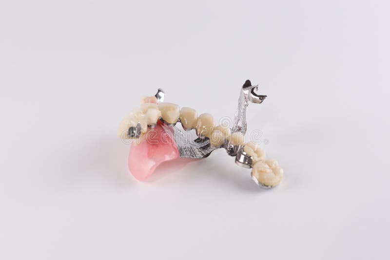 Clasp Prosthesis with Attachments Fixing Ceramic Crowns Stock Image ...