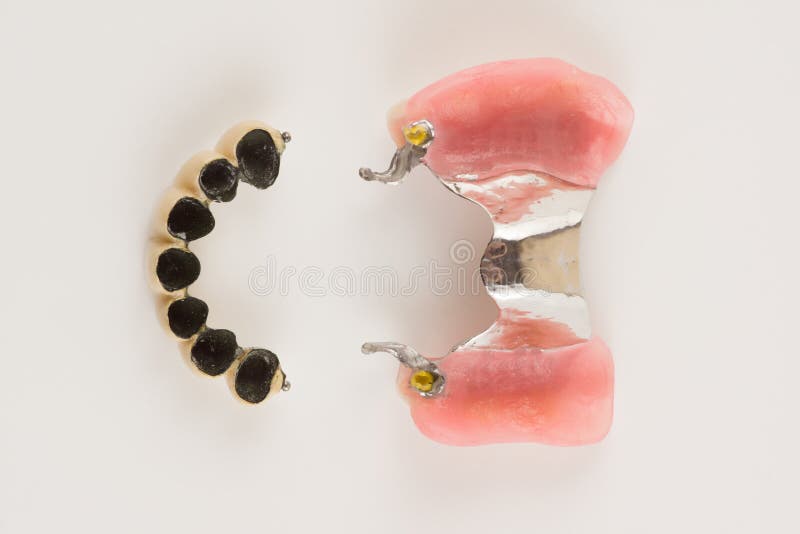 Clasp Prosthesis with and Latch Ceramic Crowns Stock Photo - Image of ...