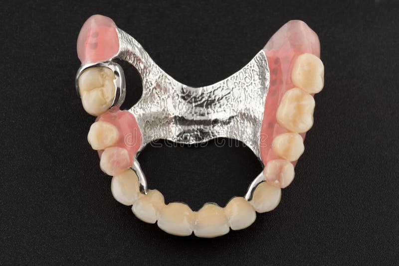 Clasp Prosthesis with Lock Fixation Stock Photo - Image of medicine ...