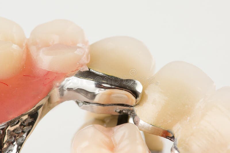 Dental Implant of Upper Jaw Stock Image - Image of upper, maxilla: 90653861