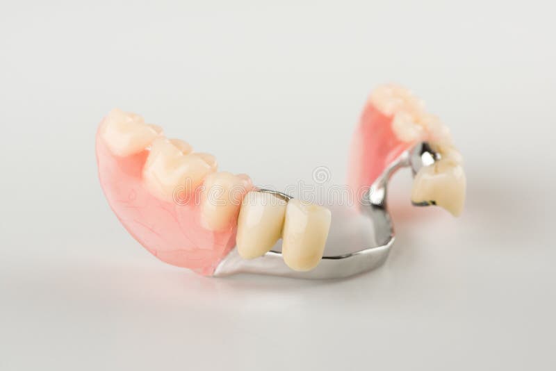 Clasp Prosthesis with Lock Fixation Stock Image - Image of crown ...