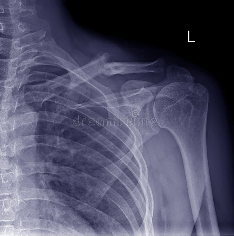 Clavicle Fracture Digital Radiograph Stock Image - Image of joint ...