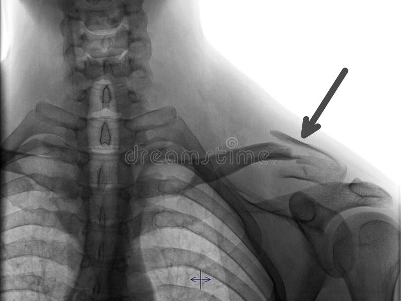 Fissazione Rotta Dell'osso Della Clavicola, Riparazione Di Frattura ...