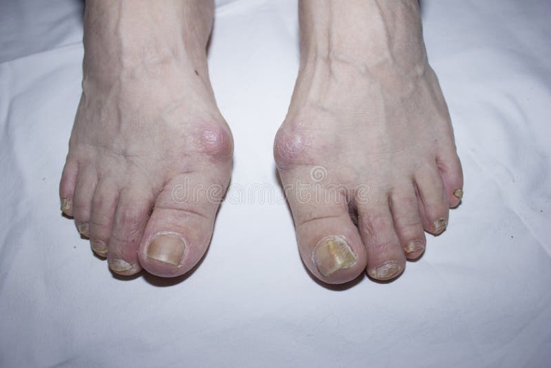 Pies enfermos imagen de archivo. Imagen de hombre, pies - 644933