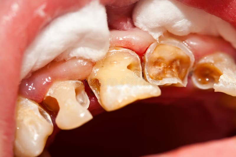 Cleaned cavities stock image. Image of medicine, caries - 24073001