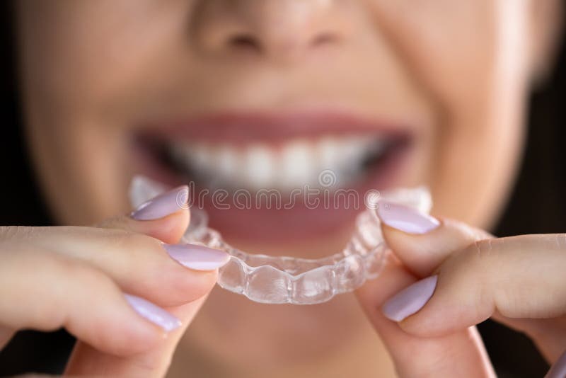 Clear Aligner Dental Night Guard Stock Photo - Image of treatment ...