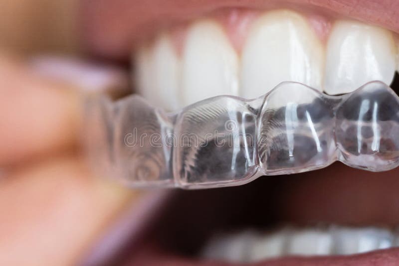 Clear Dental Aligners - Night Guard Stock Image - Image of woman ...