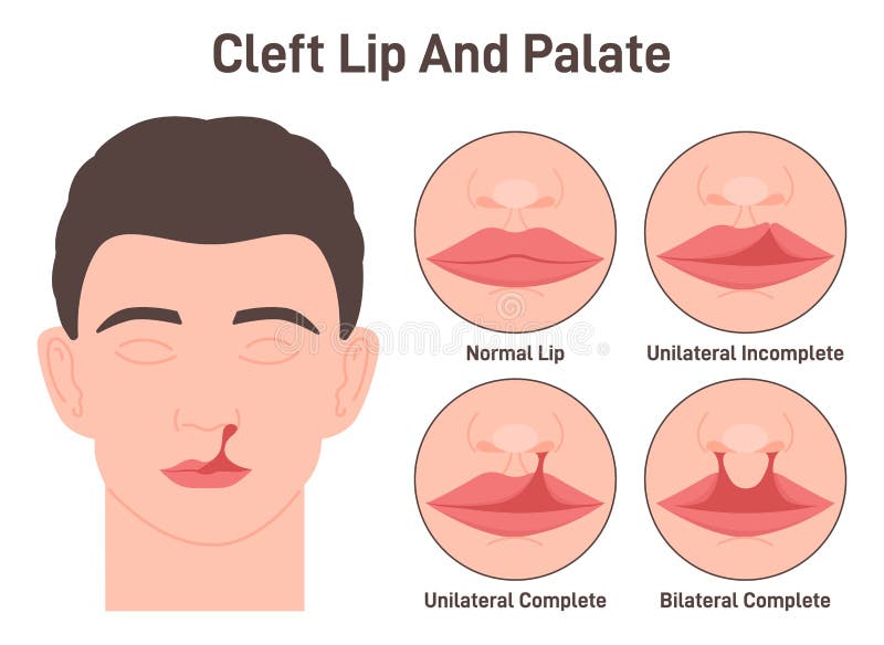 Cleft Lip Stock Illustrations – 36 Cleft Lip Stock Illustrations ...