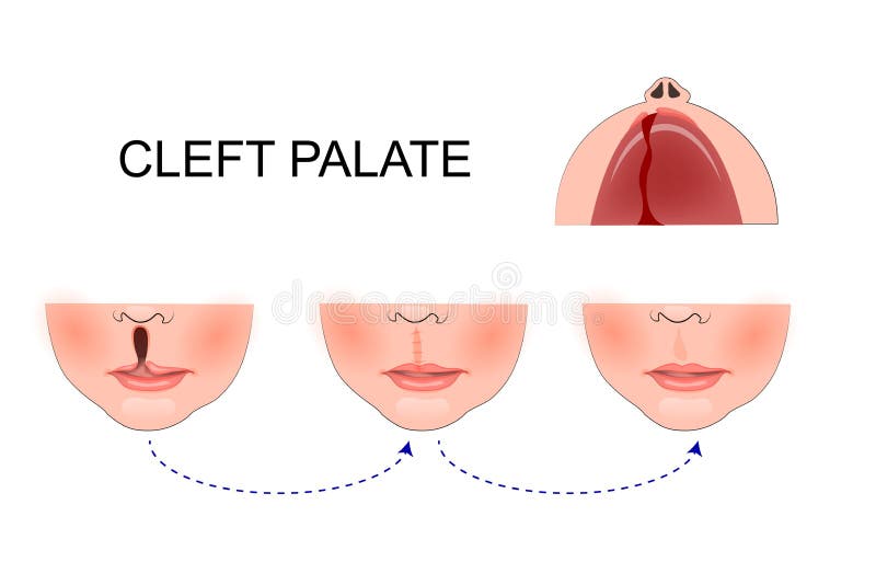 Cleft Palate Stock Illustrations – 68 Cleft Palate Stock Illustrations, Vectors & Clipart ...